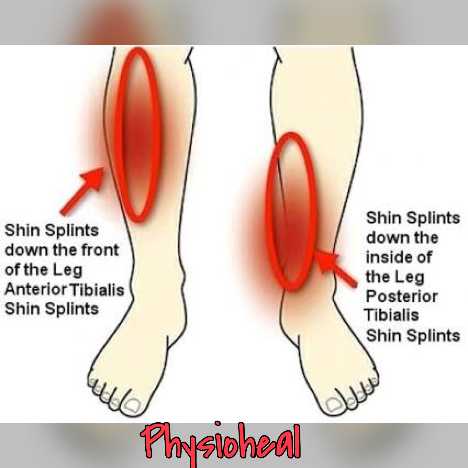 Shin Splints - Shin bone pain ! Physiotherapy as a cure ?.. - PhysioHeal