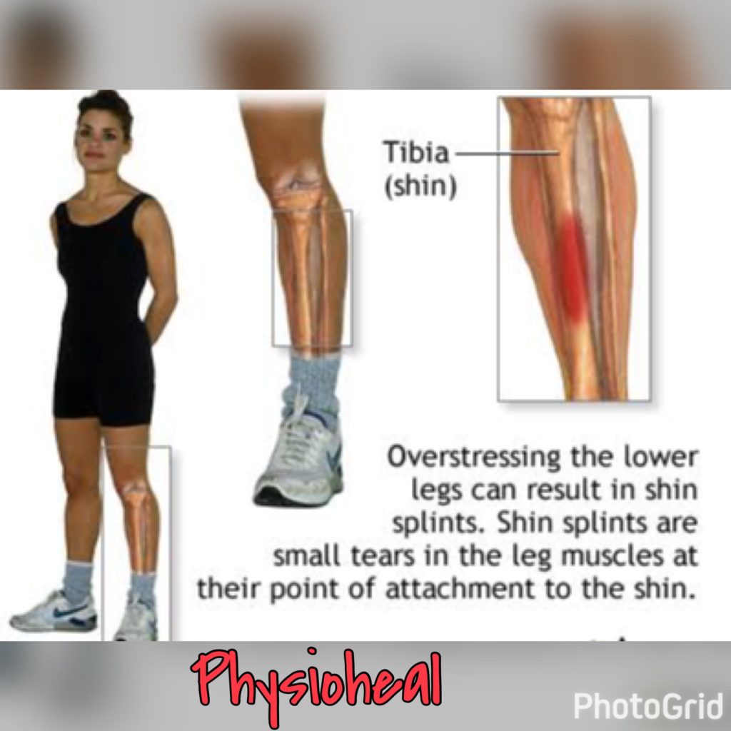 Shin Splints - Shin bone pain ! Physiotherapy as a cure ?.. - PhysioHeal