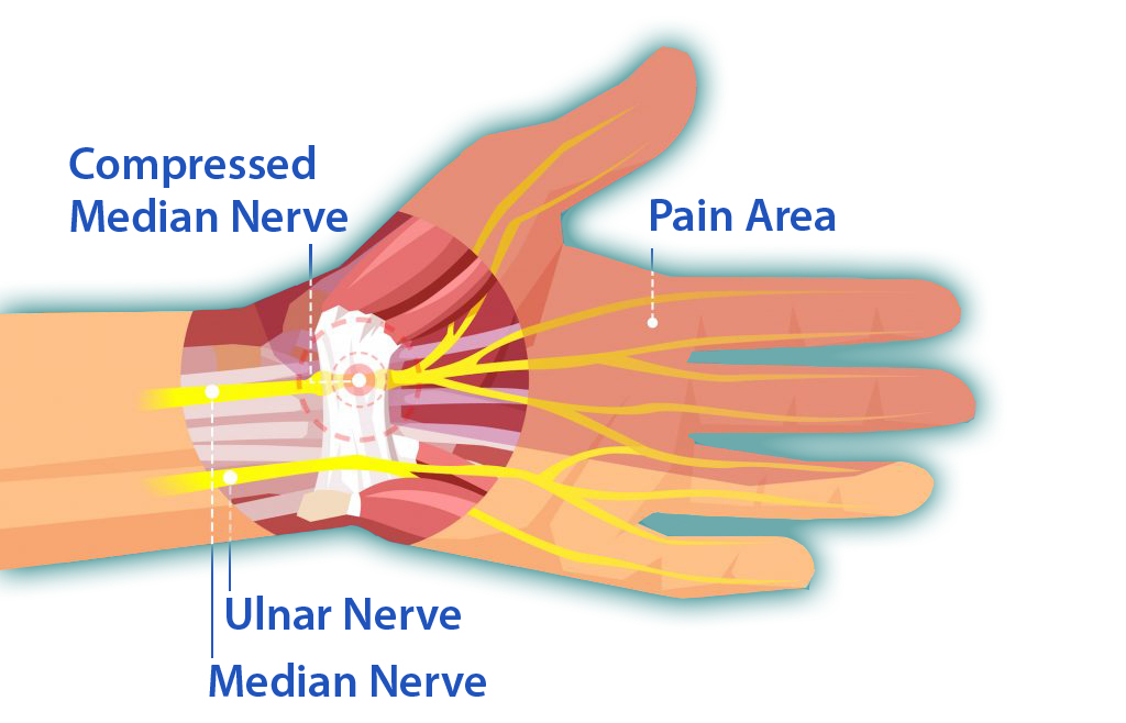 Carpal Tunnel Syndrome - PhysioHeal Best Physiotherapy Clinic in Gurgaon